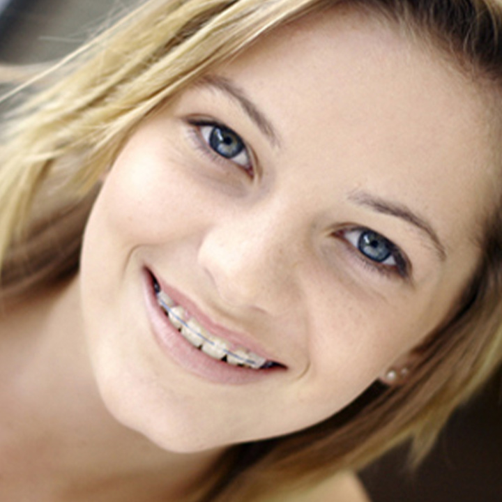 Inspire ICE™ - Walton & Maready Orthodontics